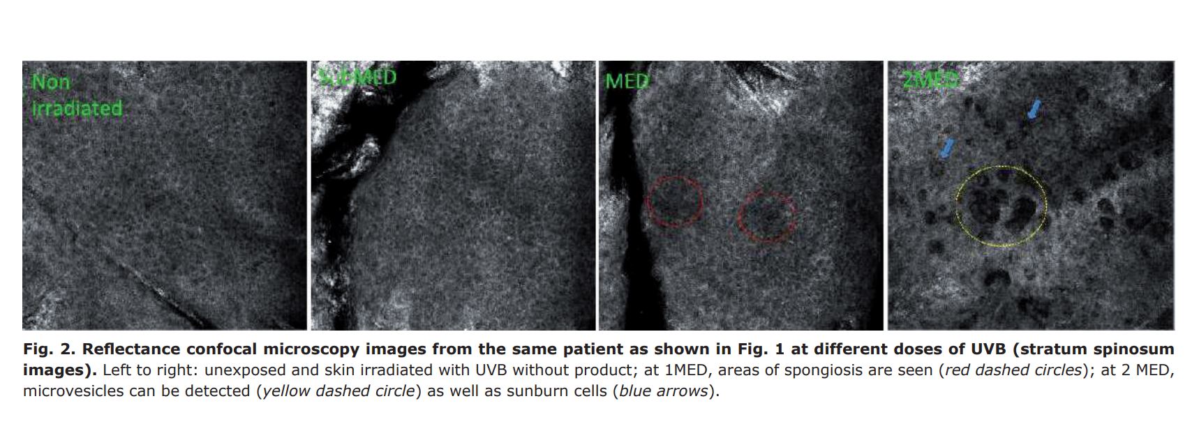 Visualizing how a daily sunscreen can protect the skin from UV damage ...